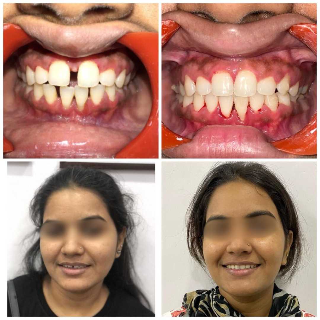Smile Correction at Orthosquare: Expert Smile Designers