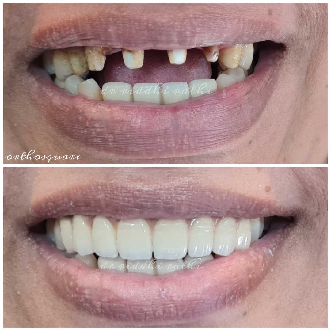 Smile Correction at Orthosquare: Expert Smile Designers
