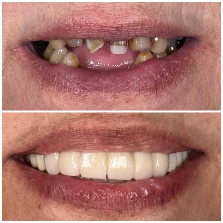 Smile Correction at Orthosquare: Expert Smile Designers