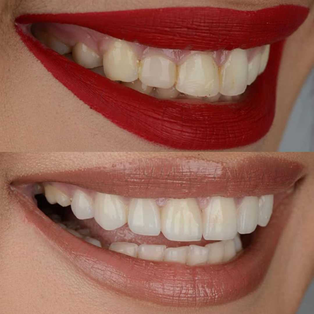 Smile Correction at Orthosquare: Expert Smile Designers