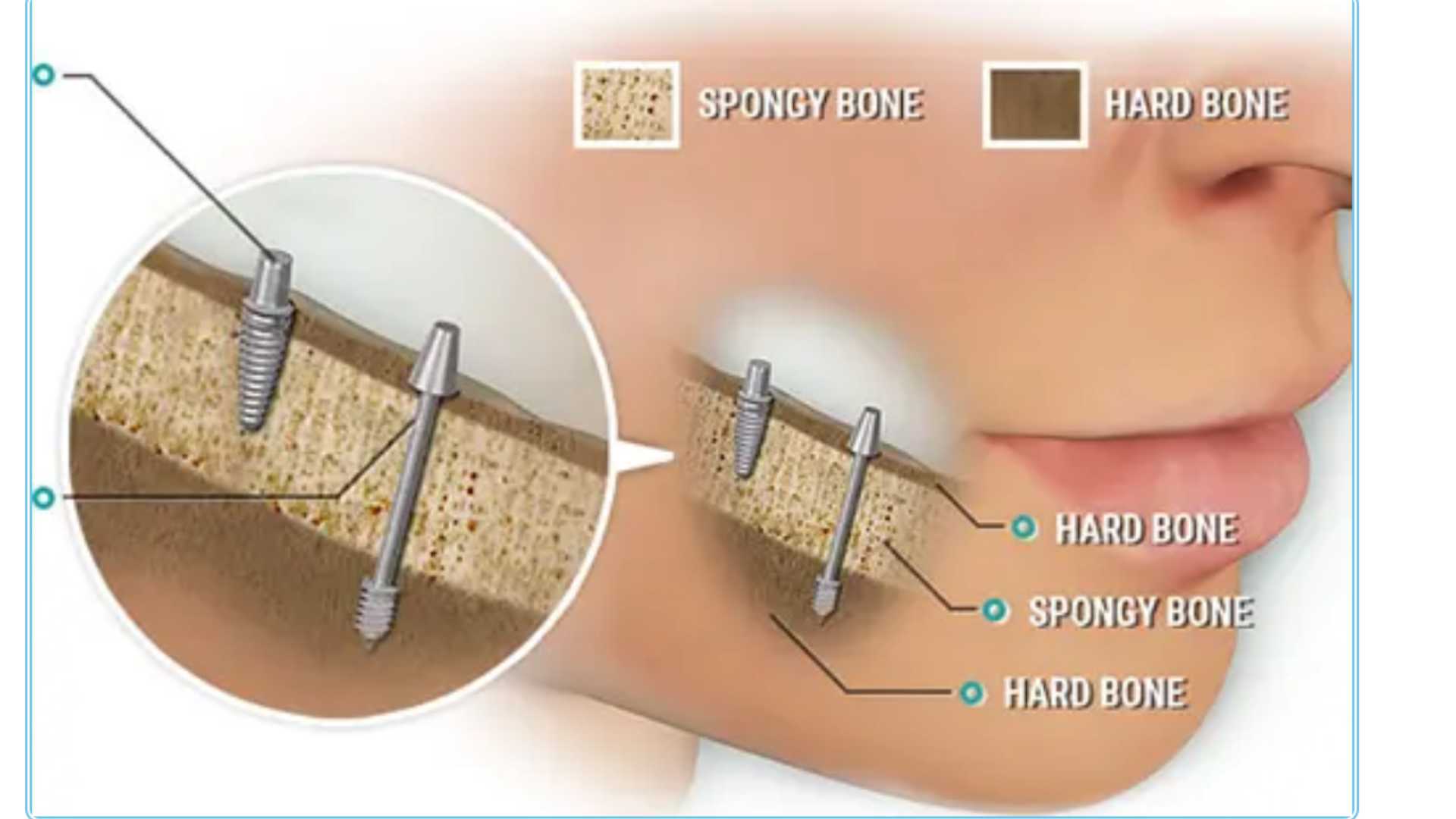 No teeth to fixed teeth in 72 hrs with basal dental implants