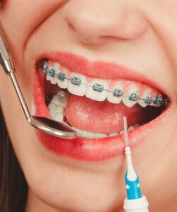 Which Braces Are Best? Here’s How to Find Your Perfect Fit