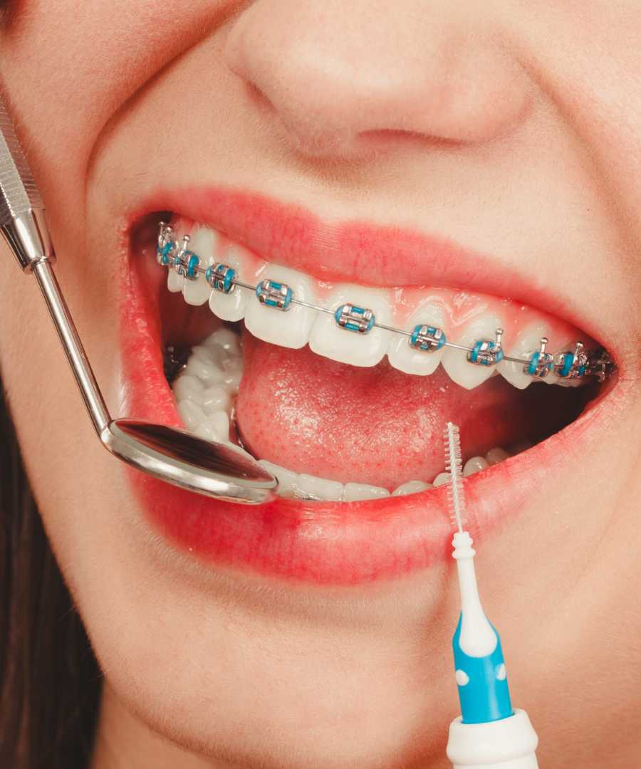 Which Braces Are Best? Here’s How to Find Your Perfect Fit