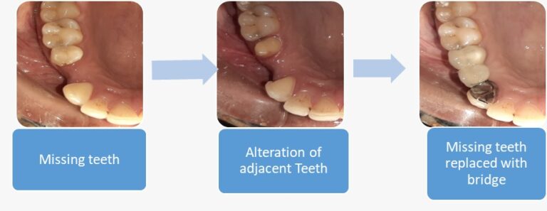 Reveal Common Dental Bridge Problems: Symptoms, & Solutions